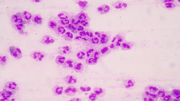 Sepsa – czym jest, jakie daje objawy i jak szybko reagować, by uniknąć ...